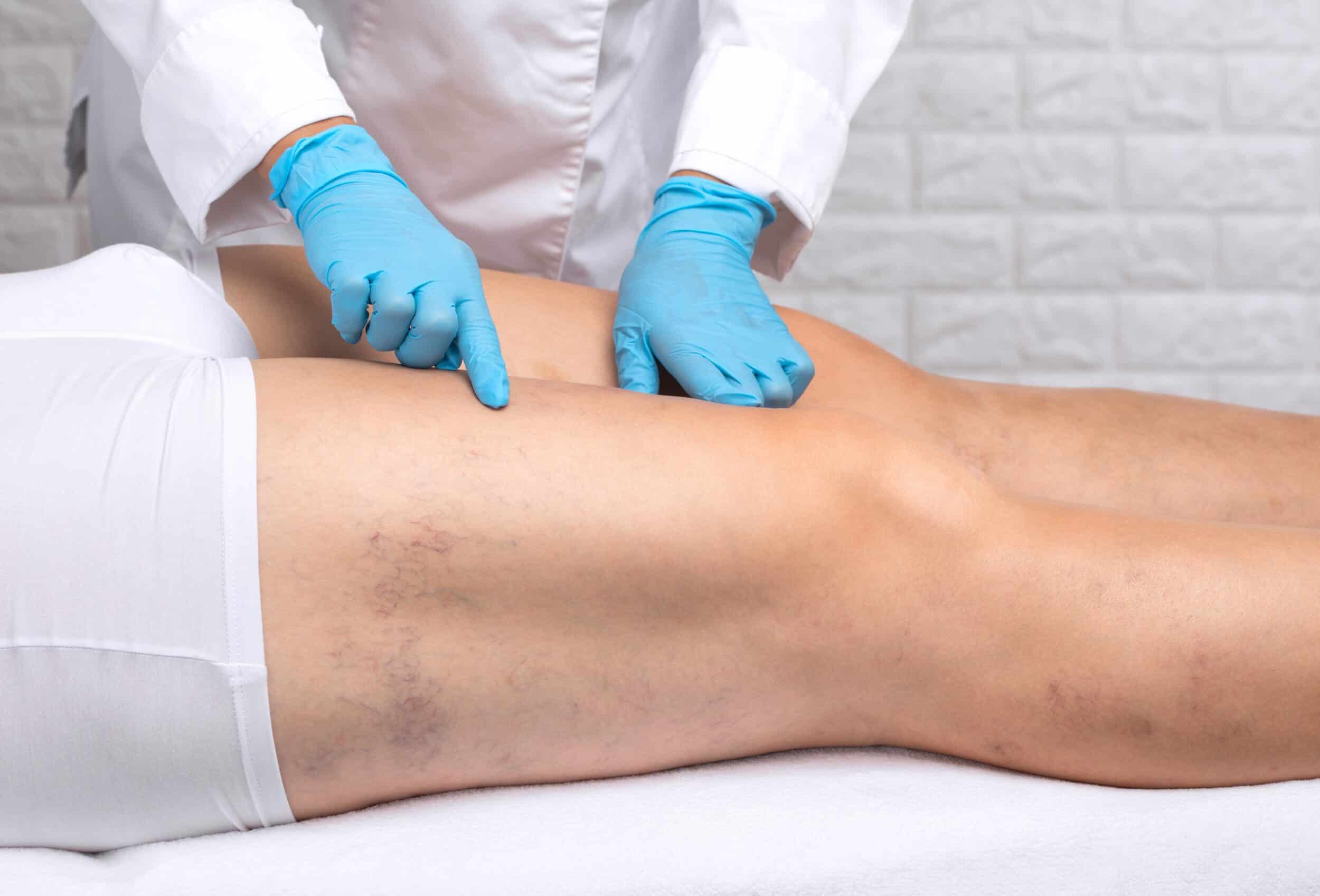 EVLT vs Vein Stripping: Key Differences Explained